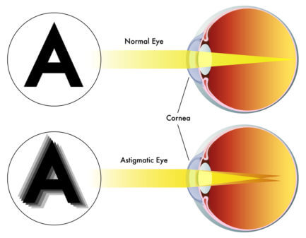 Astigmatism – Causes,Symptoms and treatment | Eye Pain Center
