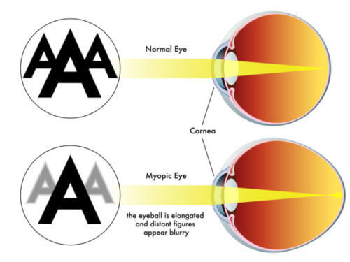 Myopia : Causes, Symptoms, Diagnosis, Types and Treatment