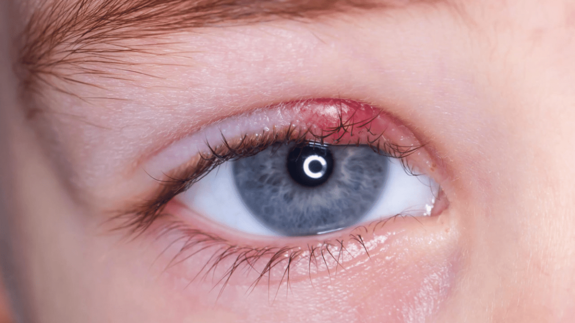 What Is An Eye Stye? Causes, symptoms, and Treatment