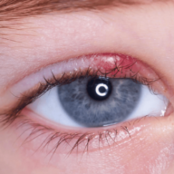 What Causes Bloodshot Red Eyes and How to Treat It?