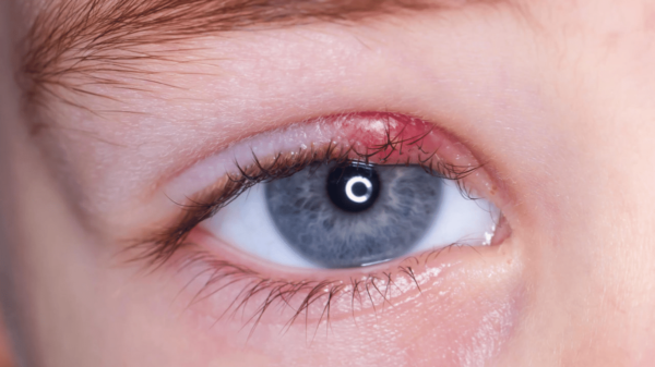 What Is An Eye Stye? Causes, symptoms, and Treatment