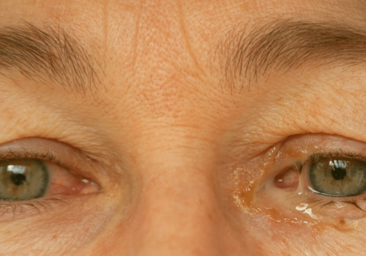 How Long is Pink Eye Contagious ? - Eye Pain Center