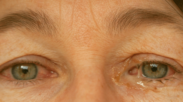 Swollen Eyelids: Causes, Symptoms & Treatment Options