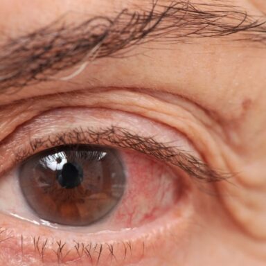 Dry Eye Syndrome: Symptoms and Causes - Eye Pain Center