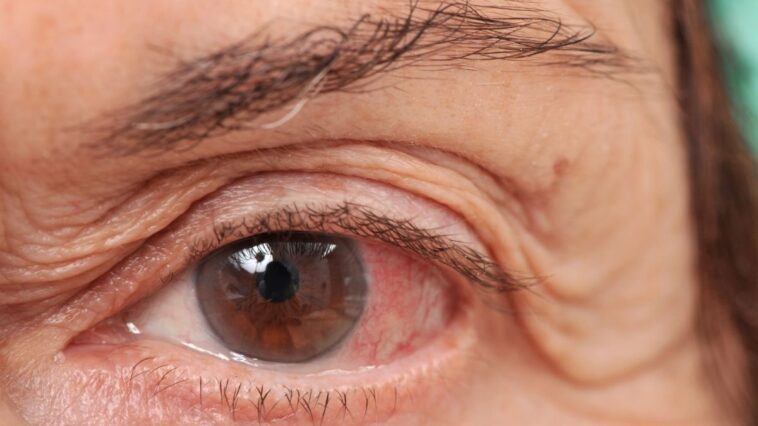 What You Need To Know About Eye Infections And How To Treat Them