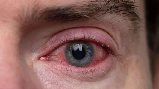 What Causes Dilated Pupils and How to Treat Them?