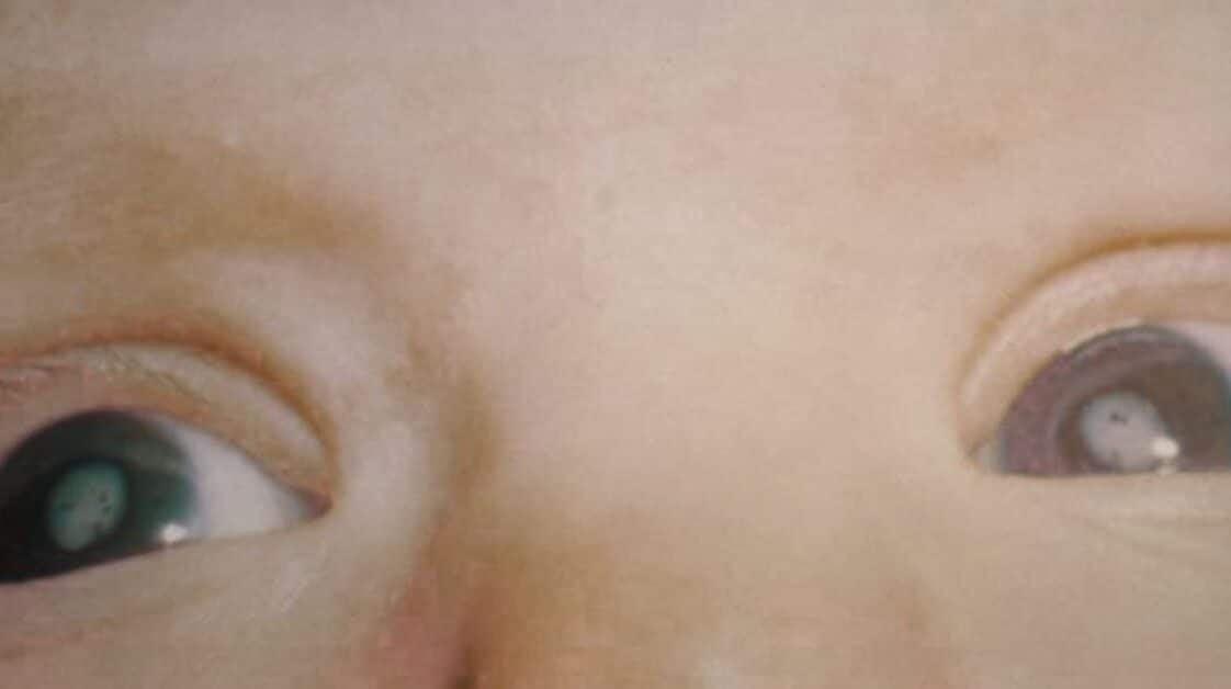 Senile Cataract: Causes, Symptoms, Diagnosis, and Treatment | Eye Pain ...