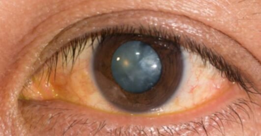 Nuclear Cataract: The Complete Guide to Diagnosis & Prevention | Eye ...