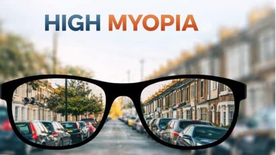 Bilateral Myopia: Causes, Symptoms, and Treatment | Eye Pain Center