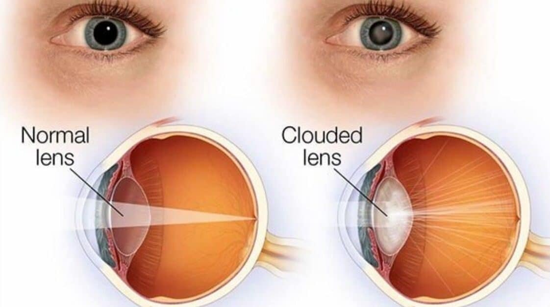 Nuclear Cataract: The Complete Guide to Diagnosis & Prevention | Eye ...